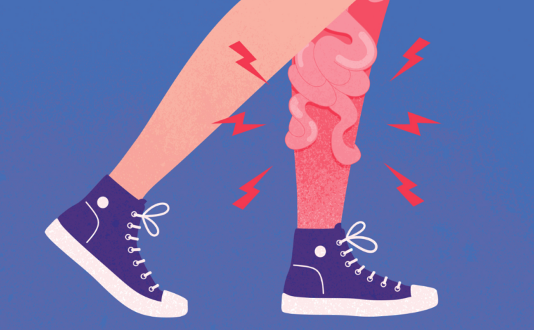 Comment reconnaître la phlébite et la soigner ? - Union Mutame